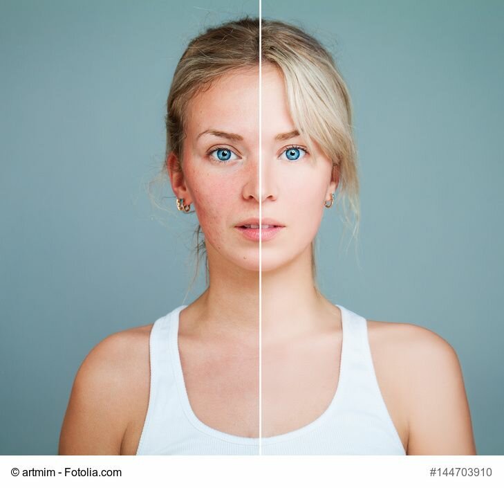 Die Rosacea-Symptome im Überblick - Rosacea Blog